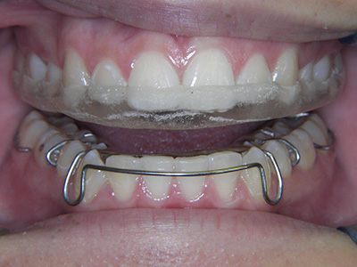 TMJ TMD Orthodontist Rye Brook NY Okun Orthodontics